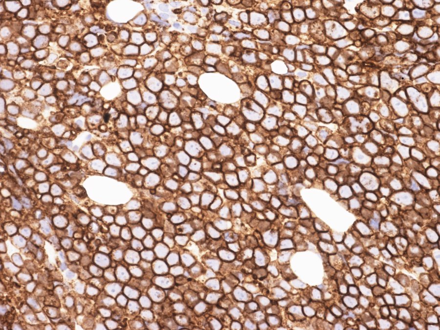 Burkitt Lymphoma – Haematological Malignancy Diagnostic Service