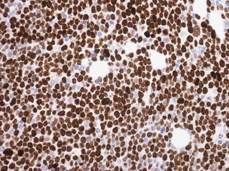 Burkitt Lymphoma – Haematological Malignancy Diagnostic Service