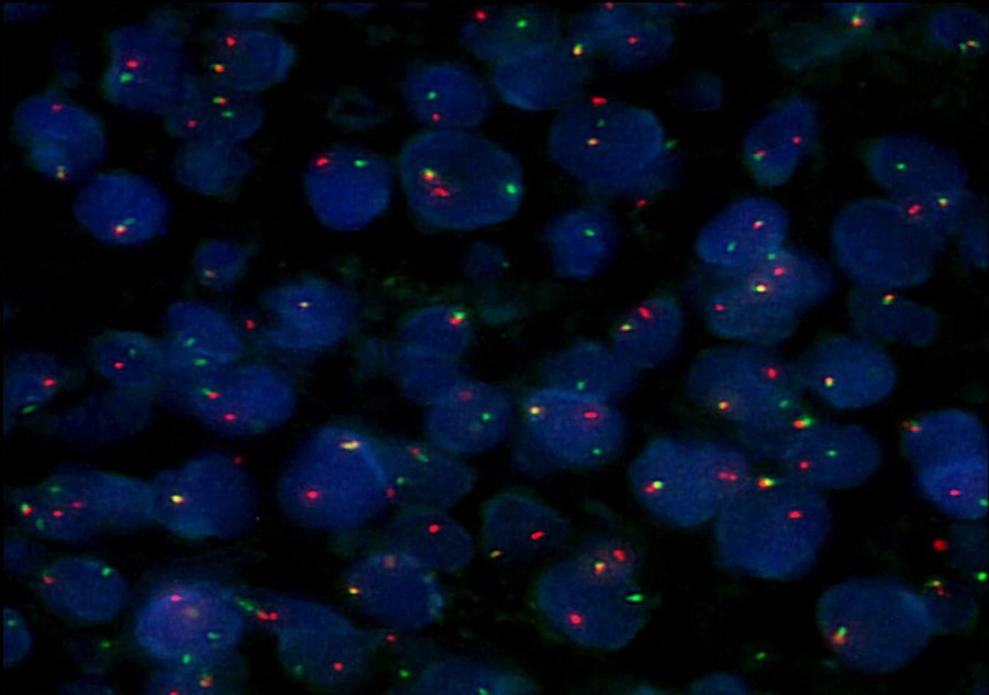 Burkitt Lymphoma – Haematological Malignancy Diagnostic Service
