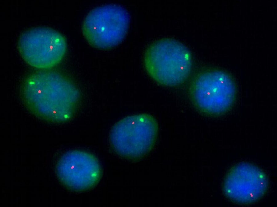 Fluorescent In Situ Hybridisation – Haematological Malignancy ...