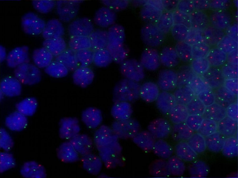 Chronic Lymphocytic Leukaemia – Haematological Malignancy Diagnostic ...