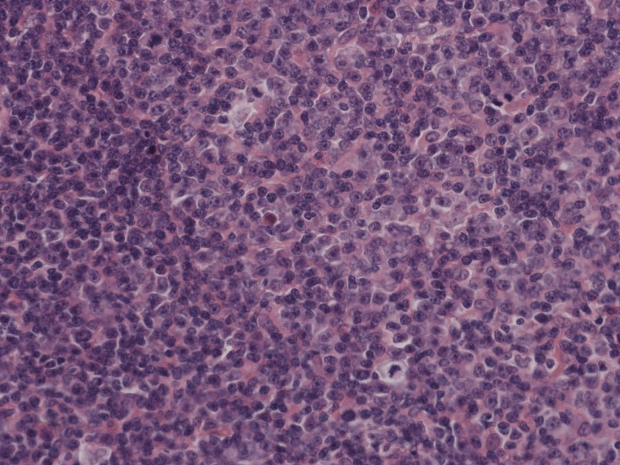 Chronic Lymphocytic Leukaemia – Haematological Malignancy Diagnostic ...