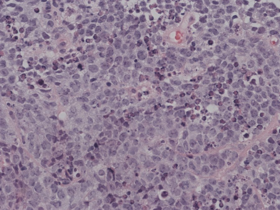 Diffuse Large B-cell Lymphoma – Haematological Malignancy Diagnostic ...