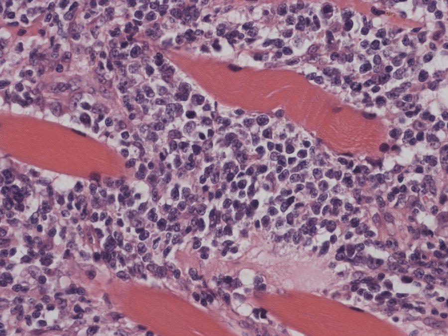 Diffuse Large B-cell Lymphoma – Haematological Malignancy Diagnostic ...