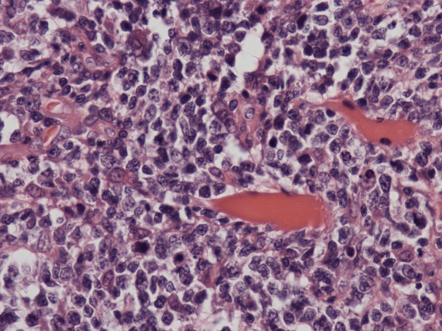 Diffuse Large B-cell Lymphoma – Haematological Malignancy Diagnostic ...