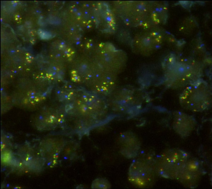 Diffuse Large B-cell Lymphoma – Haematological Malignancy Diagnostic ...