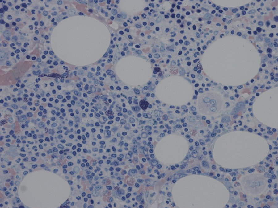 Systemic Marginal Zone Lymphoma – Haematological Malignancy Diagnostic ...