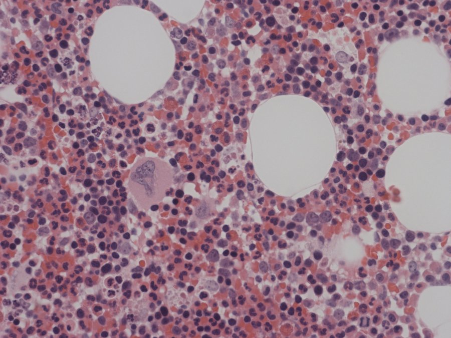 Histology & Immunohistochemistry – Haematological Malignancy Diagnostic ...